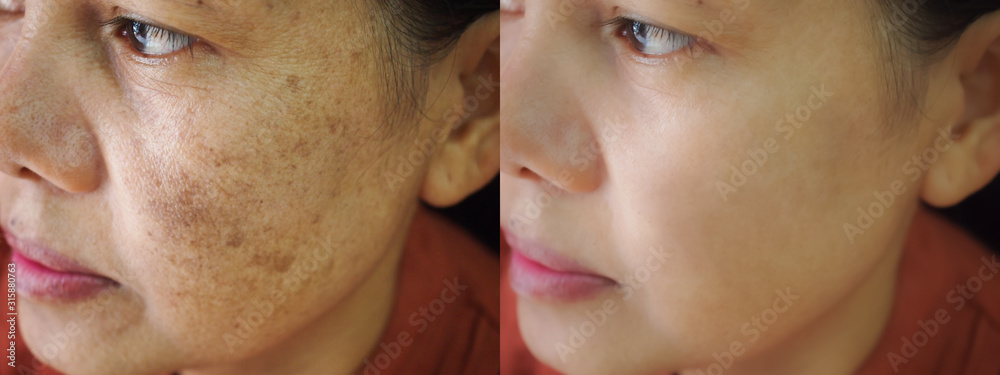 Image before and after spot melasma pigmentation facial treatment on ...