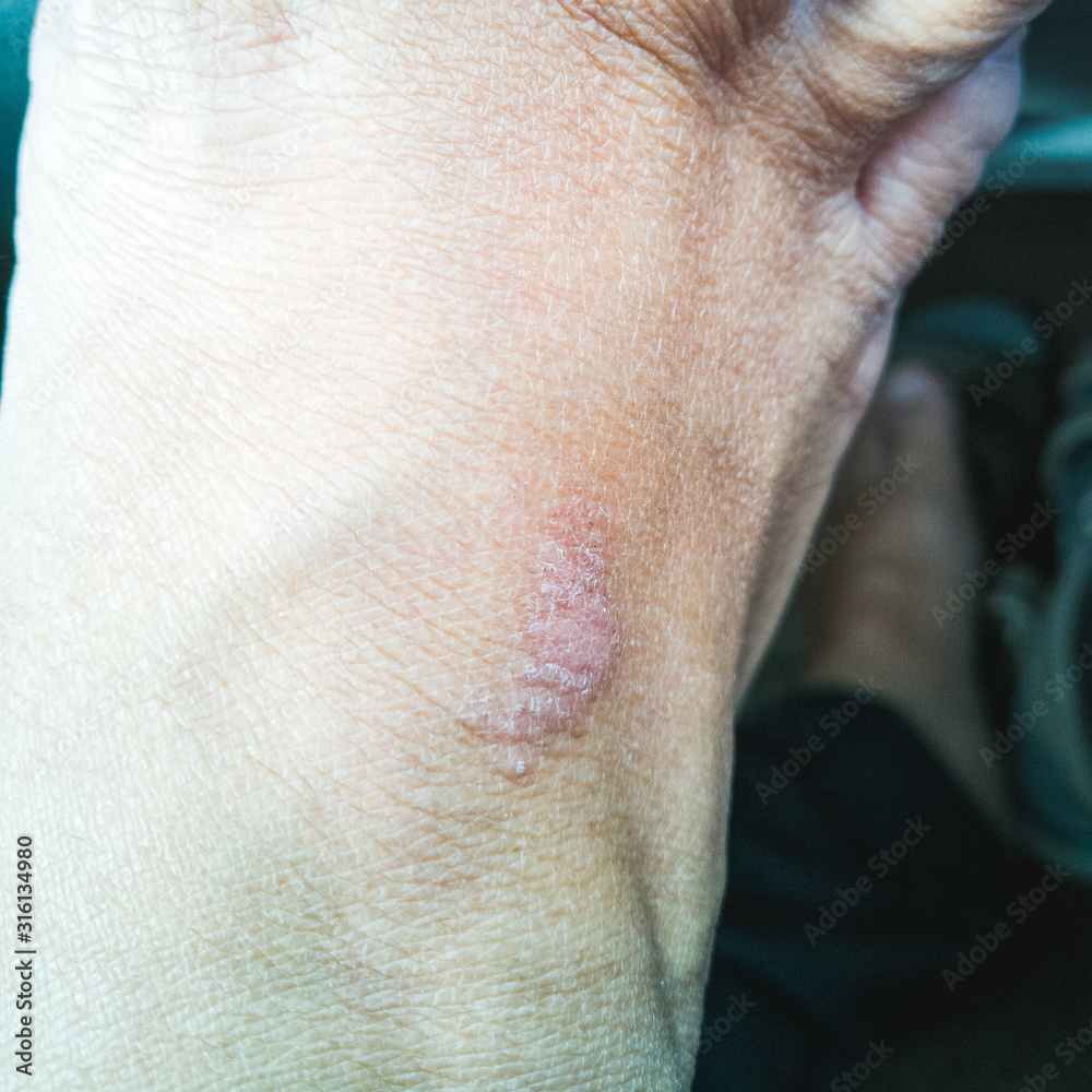 skin rash due to marine coral poisoning, that is in the healing process ...