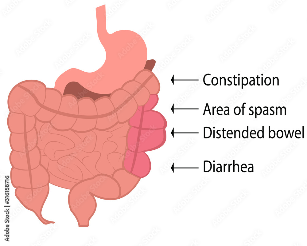 Irritable Bowel Syndrome Diagram