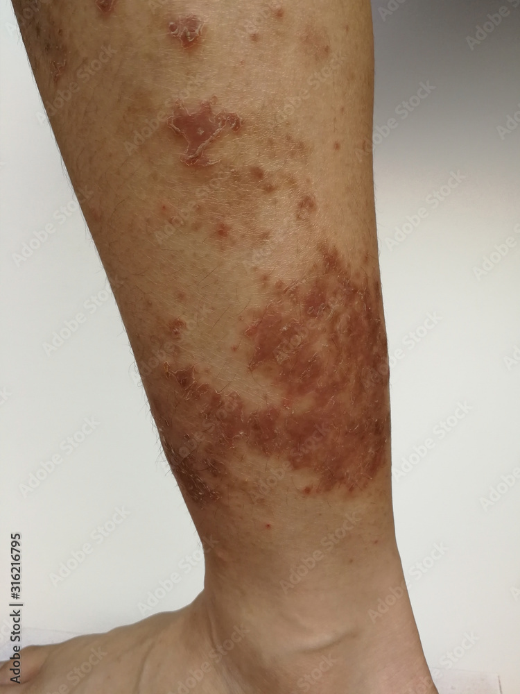 Young boy has Chronic rash on skin. Grass allergic skin disease. Atopic ...