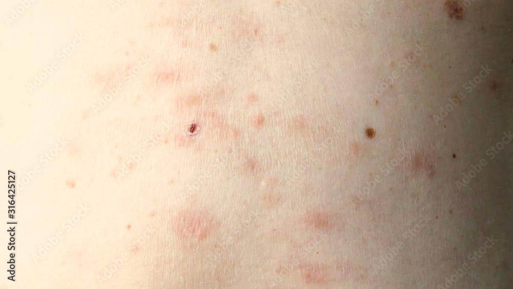 skin rash treatment on woman body. Shingles, Disease, Herpes zoster ...