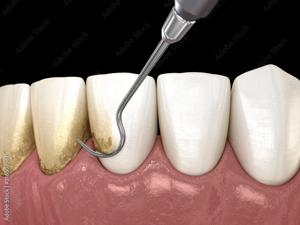 Oral hygiene: Scaling and root planing (conventional periodontal ...