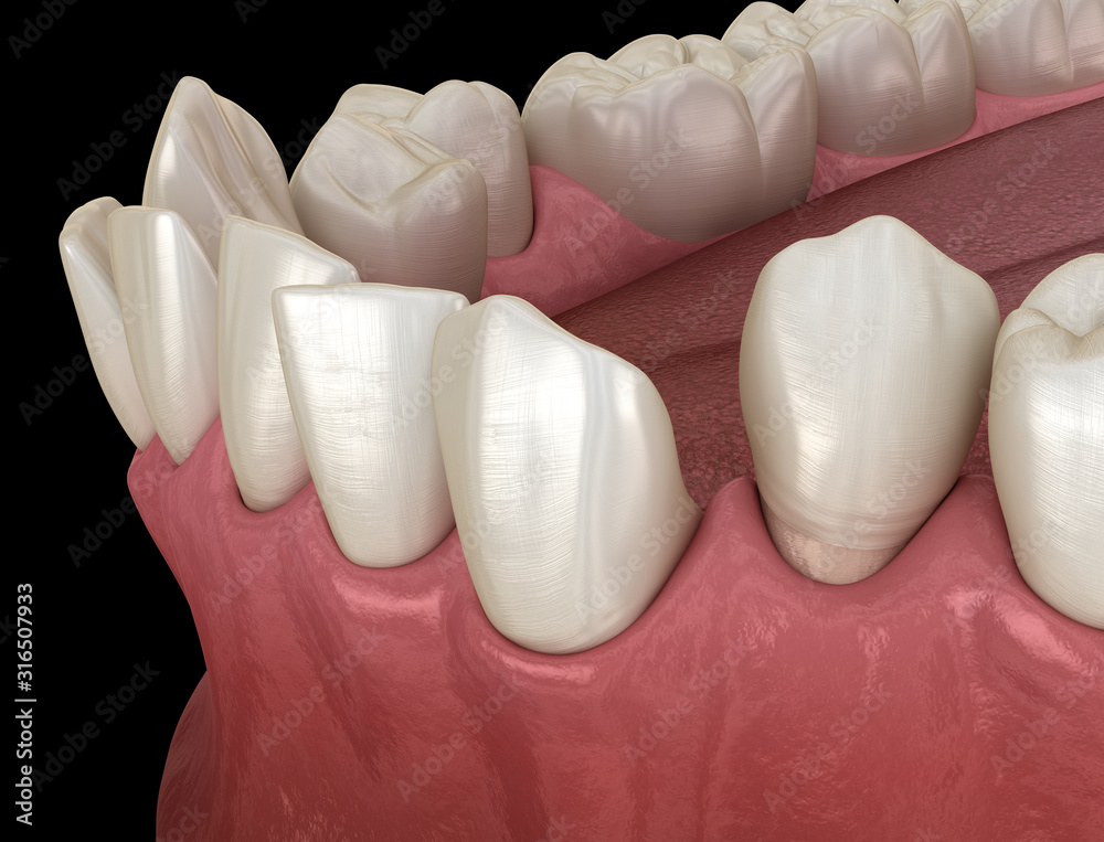 Abnormal teeth position, orthodontic concept. Medically accurate tooth ...