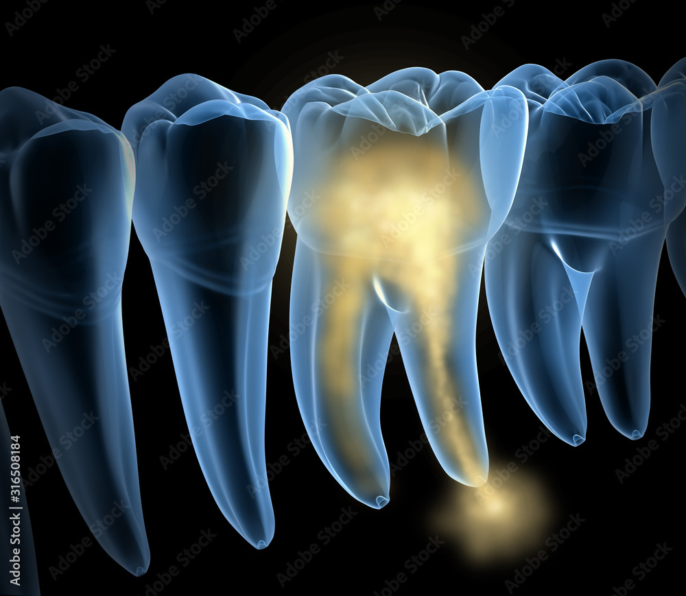 Damaged molar teeth xray view. Medically accurate tooth 3D illustration ...