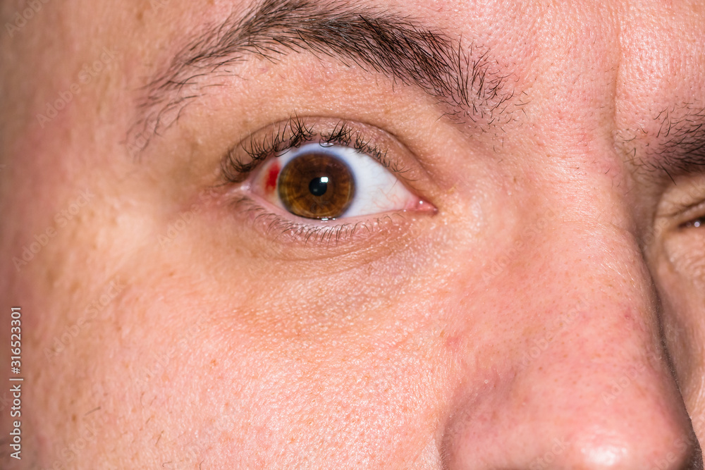 Eye injury, young man with burst blood vessel in eye, fatigue, problems ...