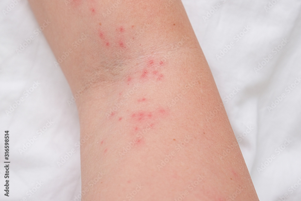 Allergic Reaction On Arms