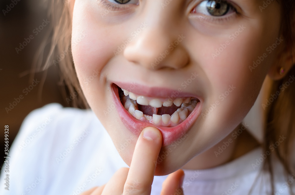 Beautiful smiling preschool girl with her first adult incisor tooth ...