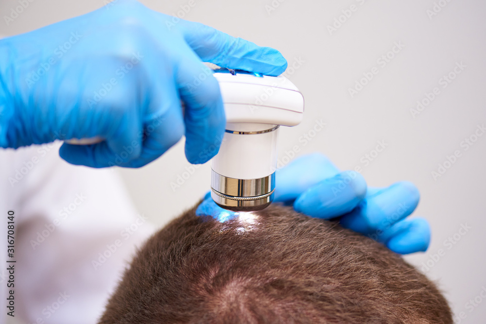 Microscopic examination of the hair and skin of the scalp. Stock Photo ...