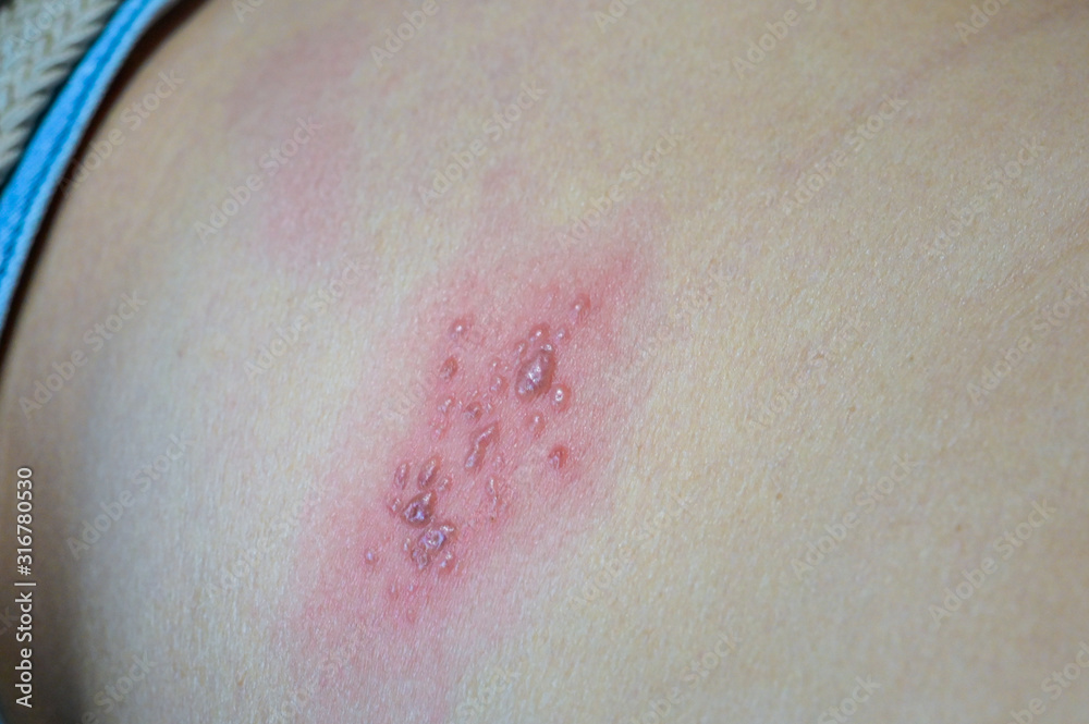 blisters caused by shingles on skin, herpes zoster Stock Photo | Adobe ...