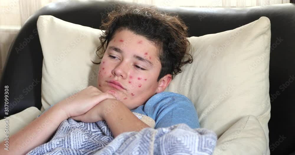 Portrait of a tired young boy suffering from chicken pox rash ...