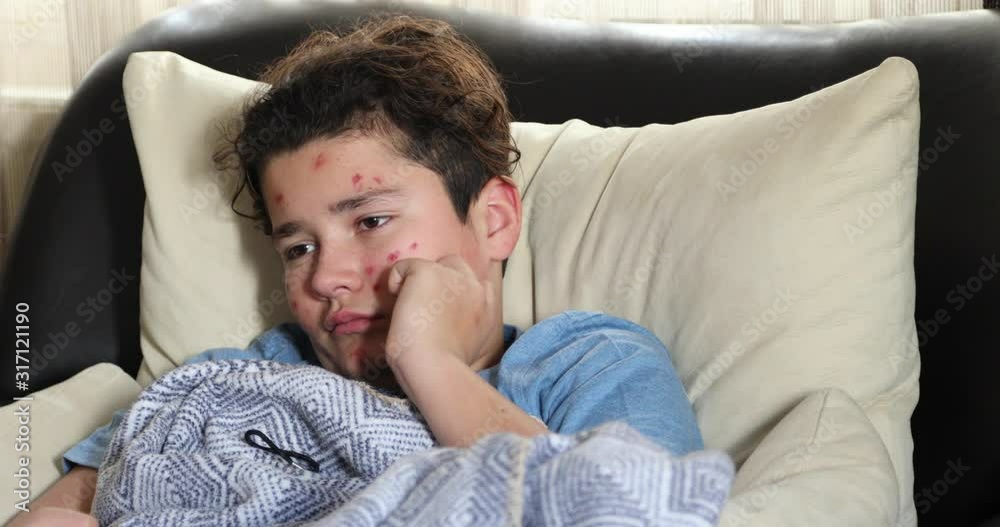 Portrait of a tired young boy suffering from chicken pox rash ...
