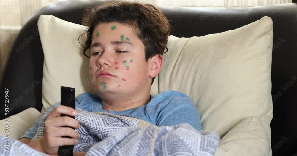 Portrait of a tired young boy suffering from chicken pox rash ...