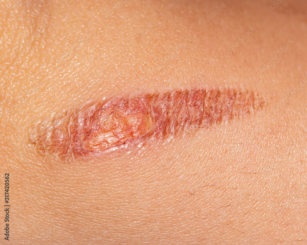 Burn Mark On Skin