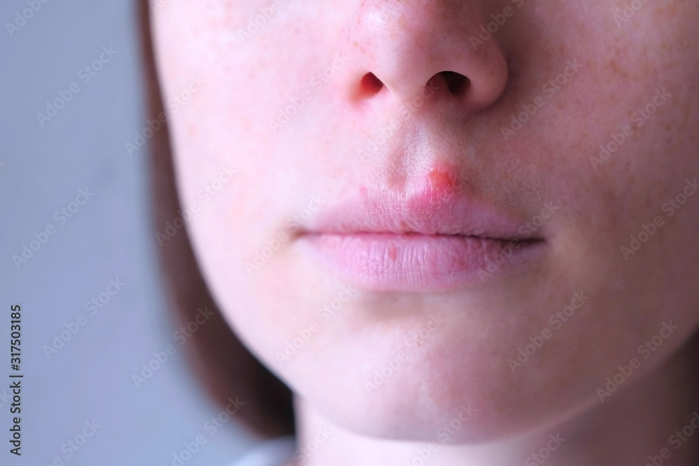 Herpes virus on human lips. Woman with herpes sore on upper lip on ...