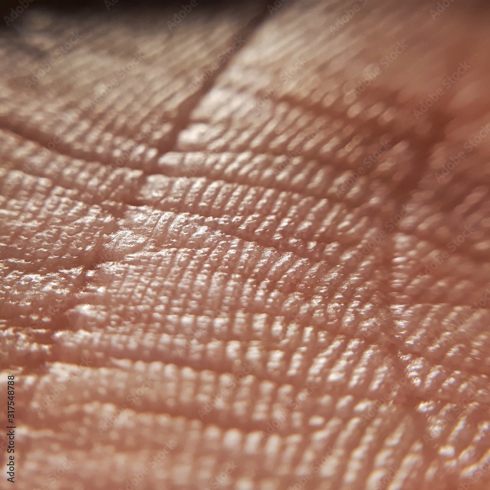 Acne concept. Skin diseases concept. macro skin of human hand.Medicine ...