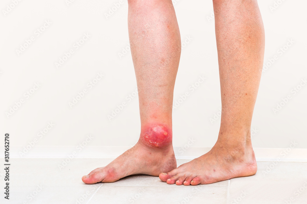 Red rash on leg of patient who was bitten by an insect Stock Photo ...