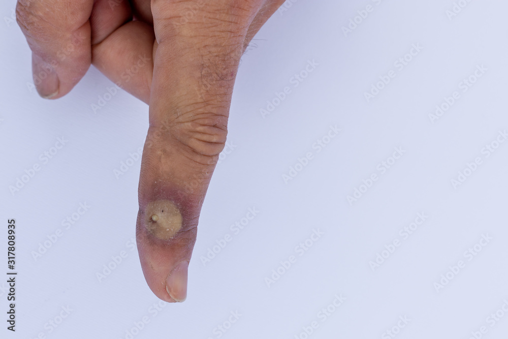 Abscesses in the finger are extremely red glowing and there is pus ...