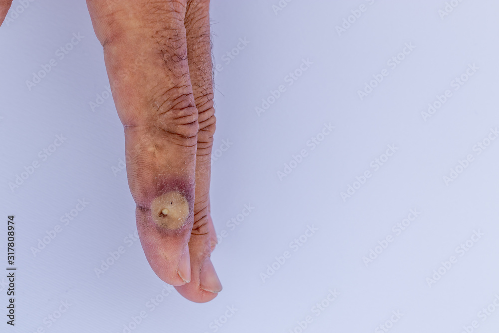 Abscesses in the finger are extremely red glowing and there is pus ...