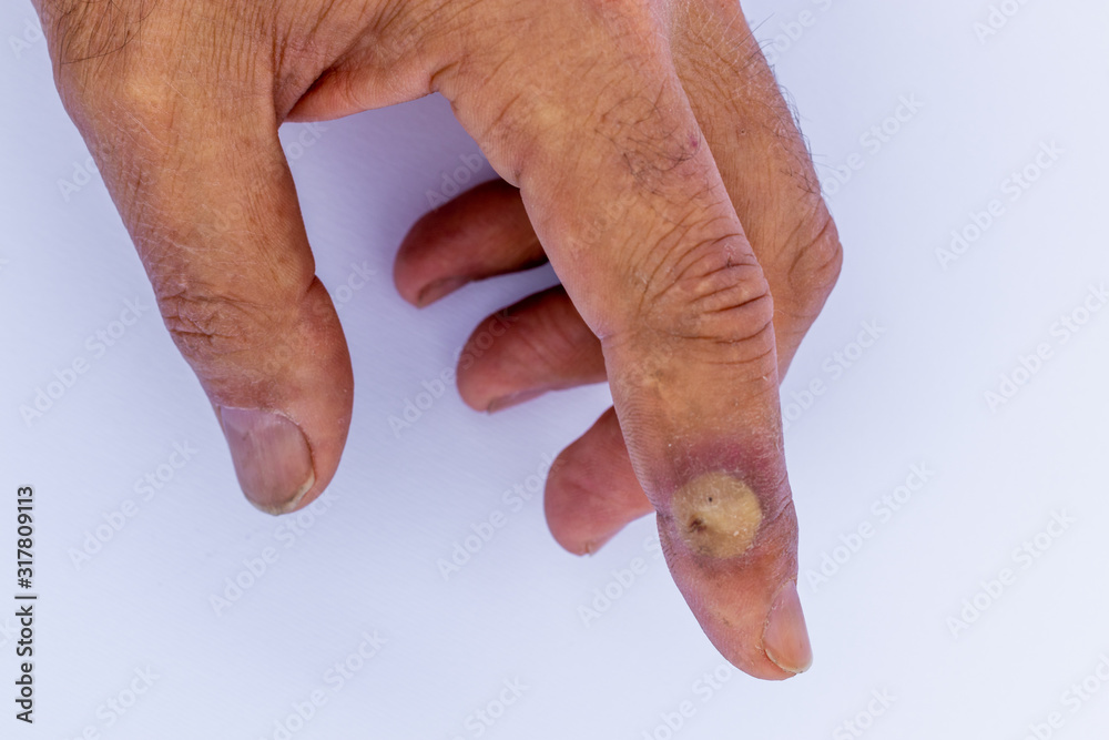 Abscesses in the finger are extremely red glowing and there is pus ...