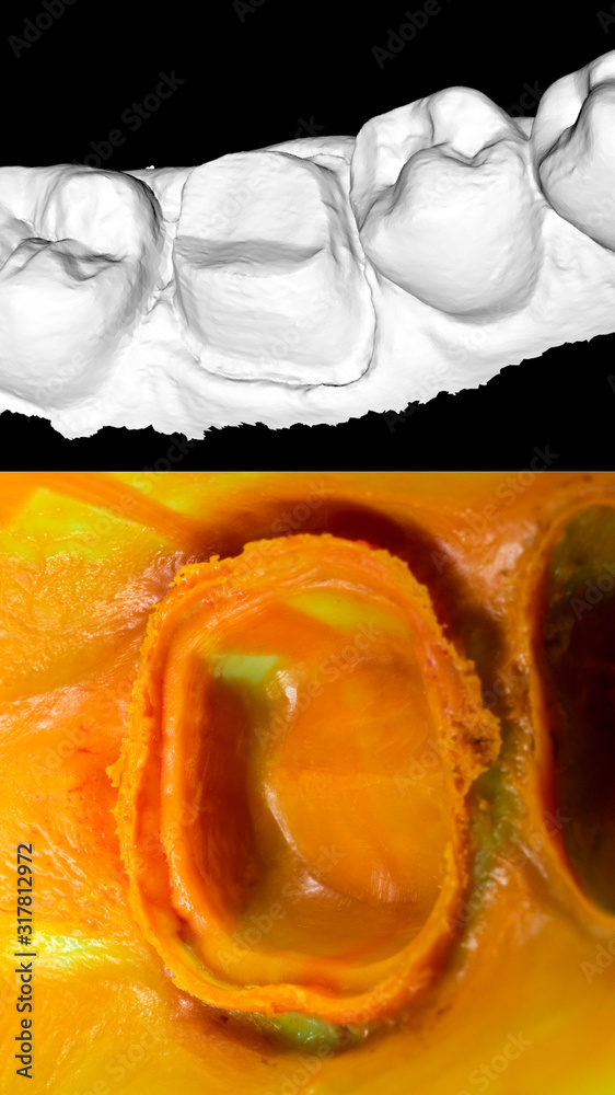 dental traditional impression by silicon vs digital impression by oral ...