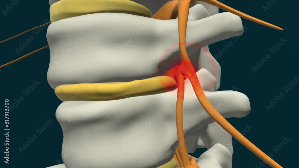 Spinal disc herniation, 3d educational animation Stock Video | Adobe Stock