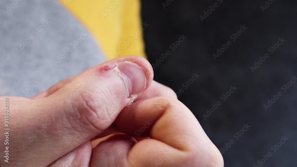 Ugly ugryzienie fingers, biting nails, cuticles, wounds on the fingers ...