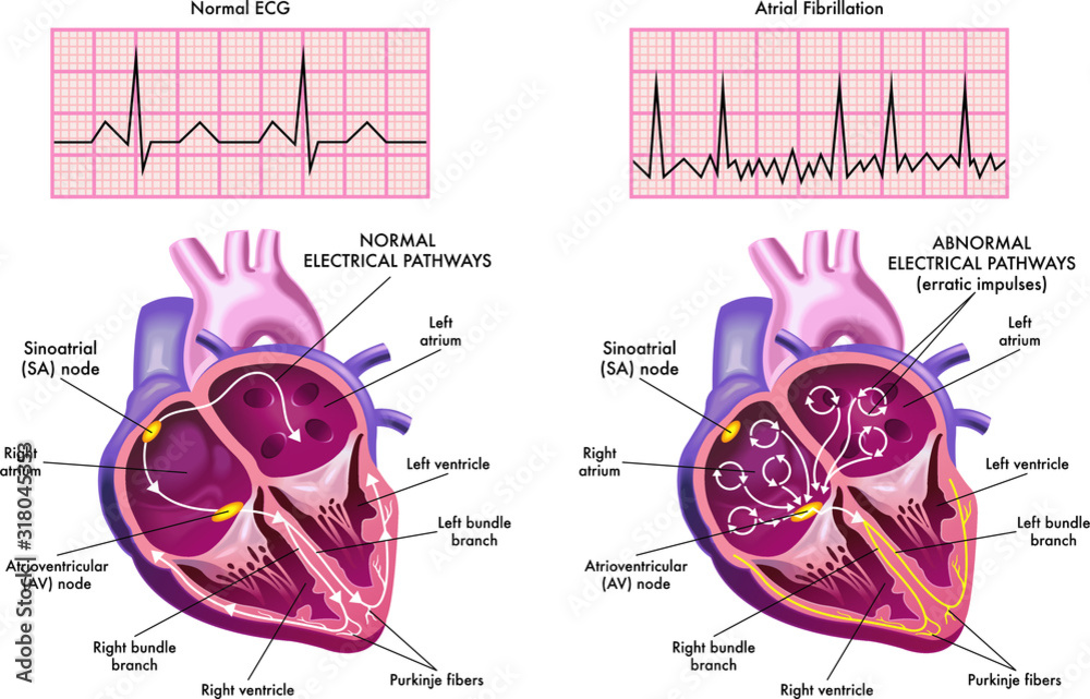 Medical illustration showing the symptoms of a heart with atrial ...