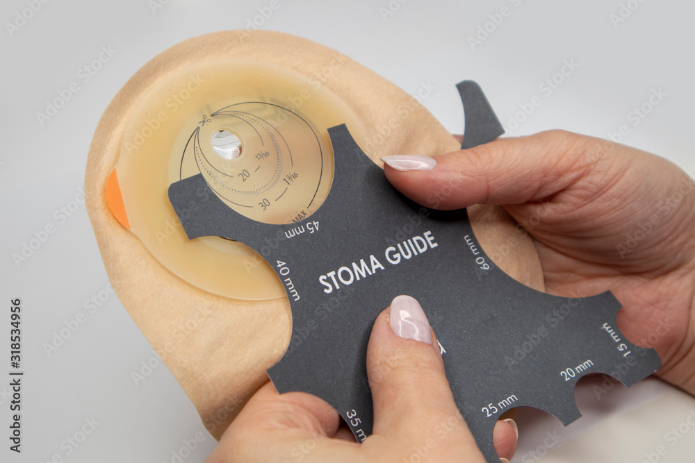 Foto de Top view on colostomy bag needed after colostomy surgery ...