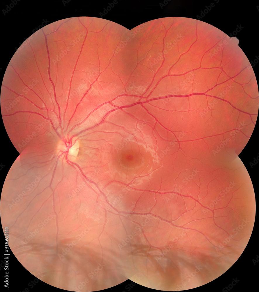 View inside human eye disorders showing retina, optic nerve and macula ...