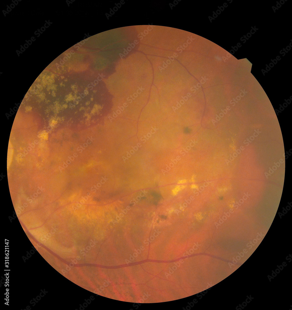 View inside human eye disorders showing retina, optic nerve and macula ...