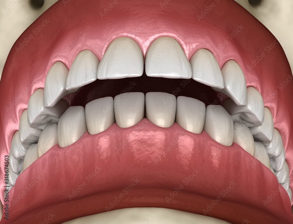 Photo & Art Print Overbite dental occlusion ( Malocclusion of teeth ...