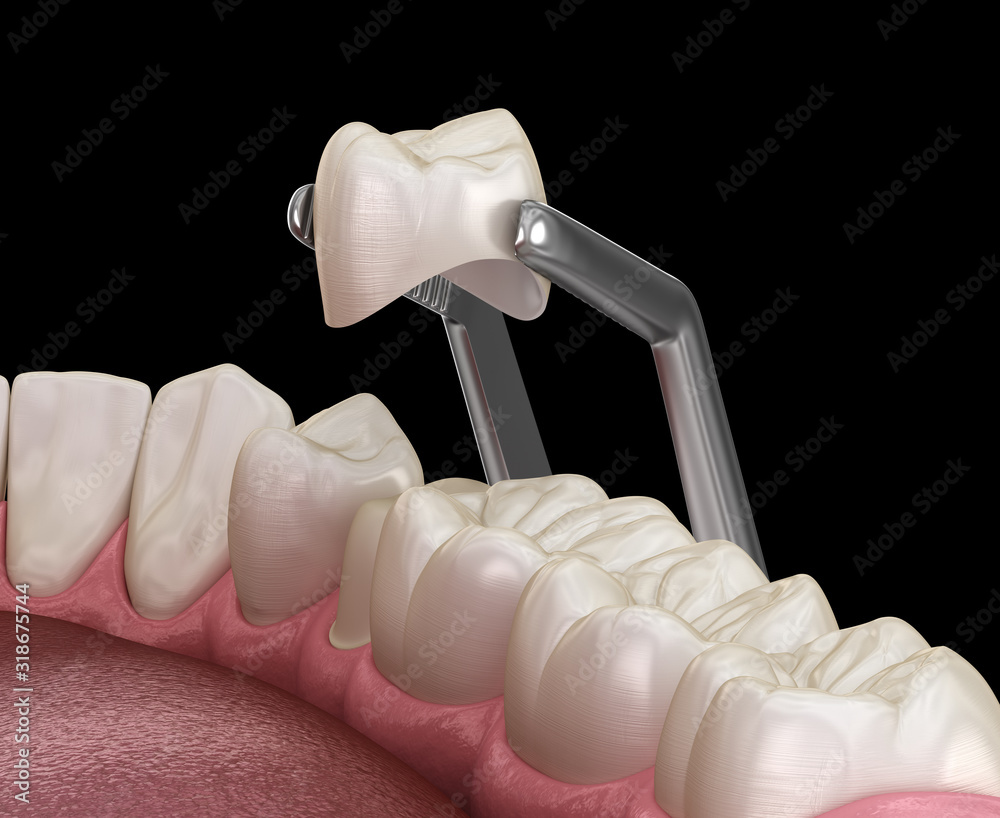 Preparated premolar tooth and ceramic crown placement. Medically ...