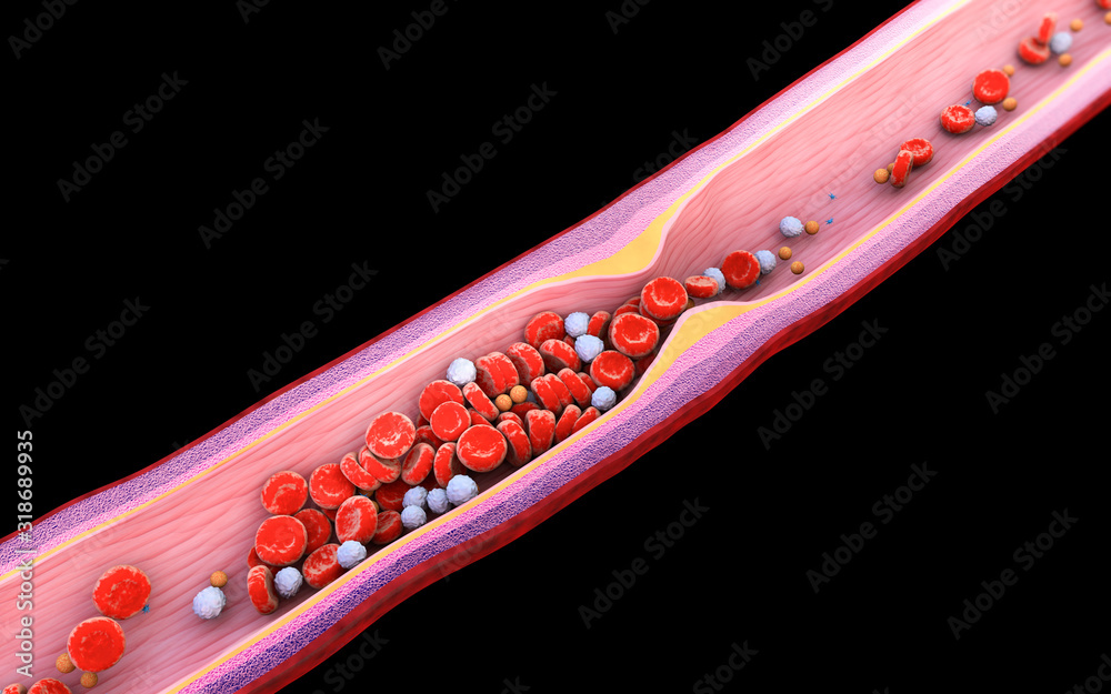 red blood cells with plaque buildup of cholesterol isolated black ...