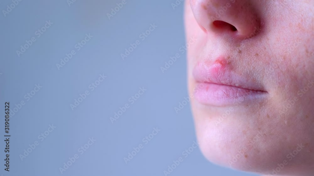 Vidéo Stock Herpes virus on human lips. Woman with herpes sore on lip ...