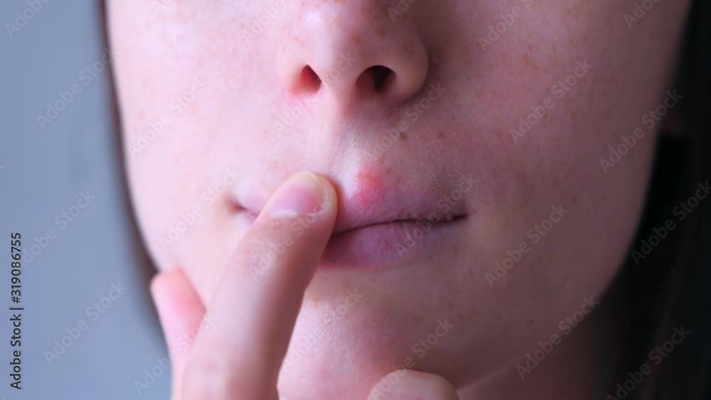 Herpes virus on human lips. Woman touching with hand herpes sore on ...