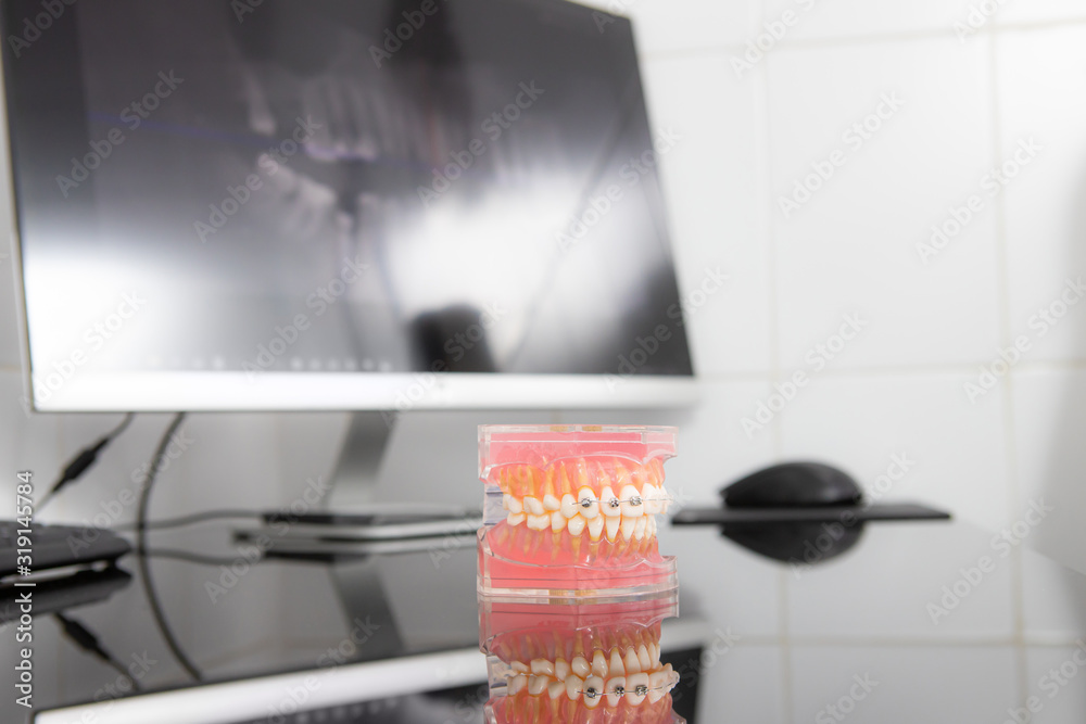 Panoramic x-ray on computer screen. Model of the jaw on the table Stock ...