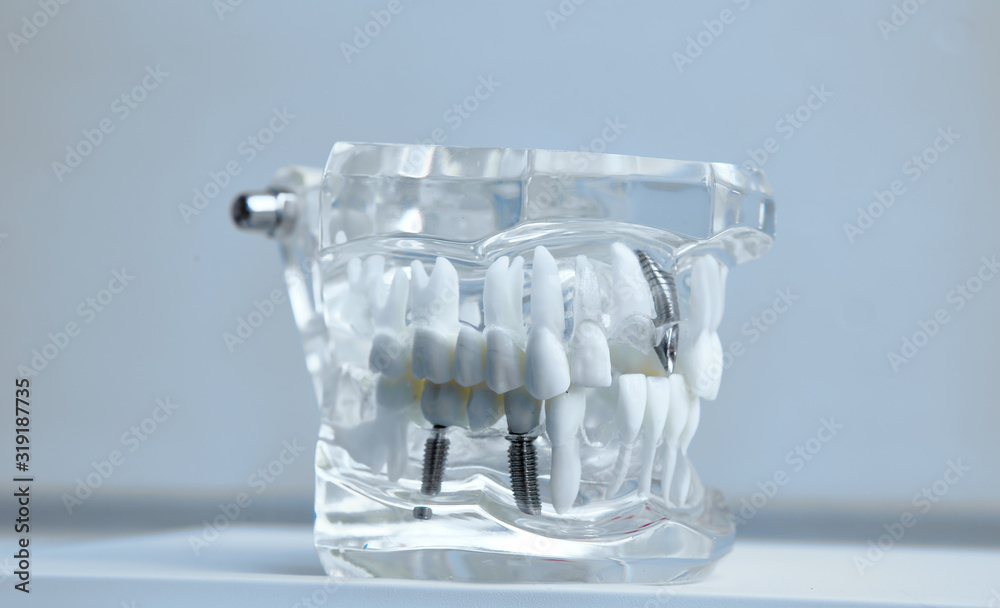 Dentists tooth plastic model with screw implant for teaching, learning ...