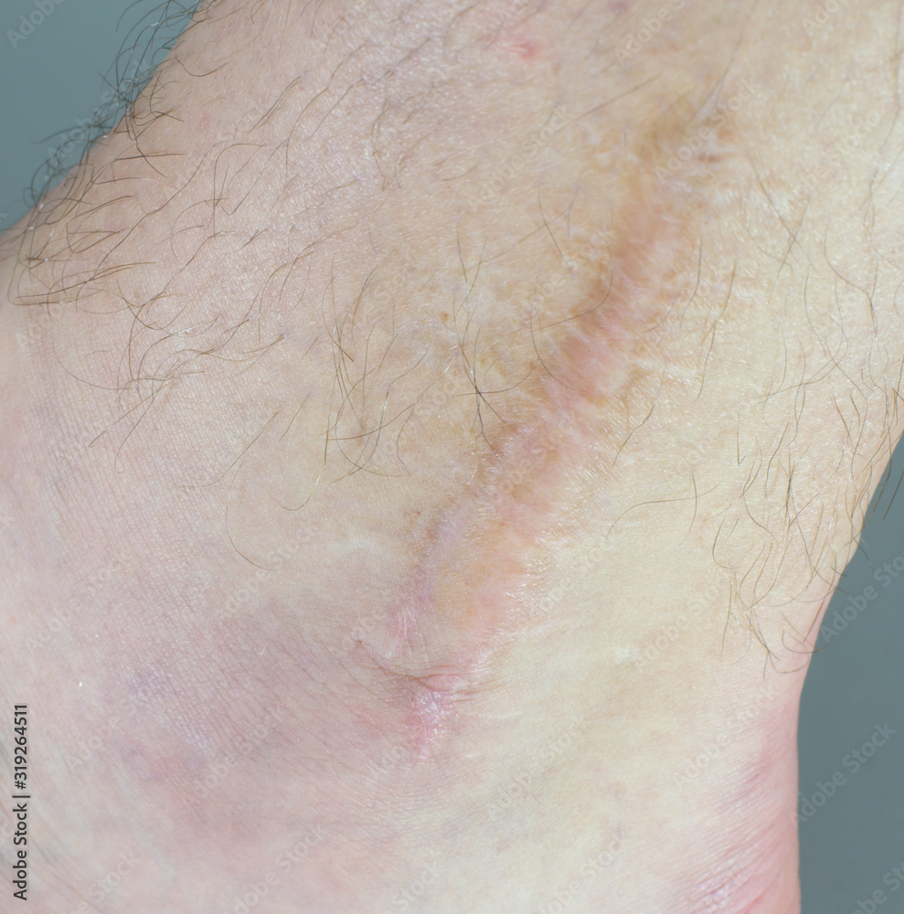 Old healed scar from surgery on a light leg. Traces of medical stitches ...