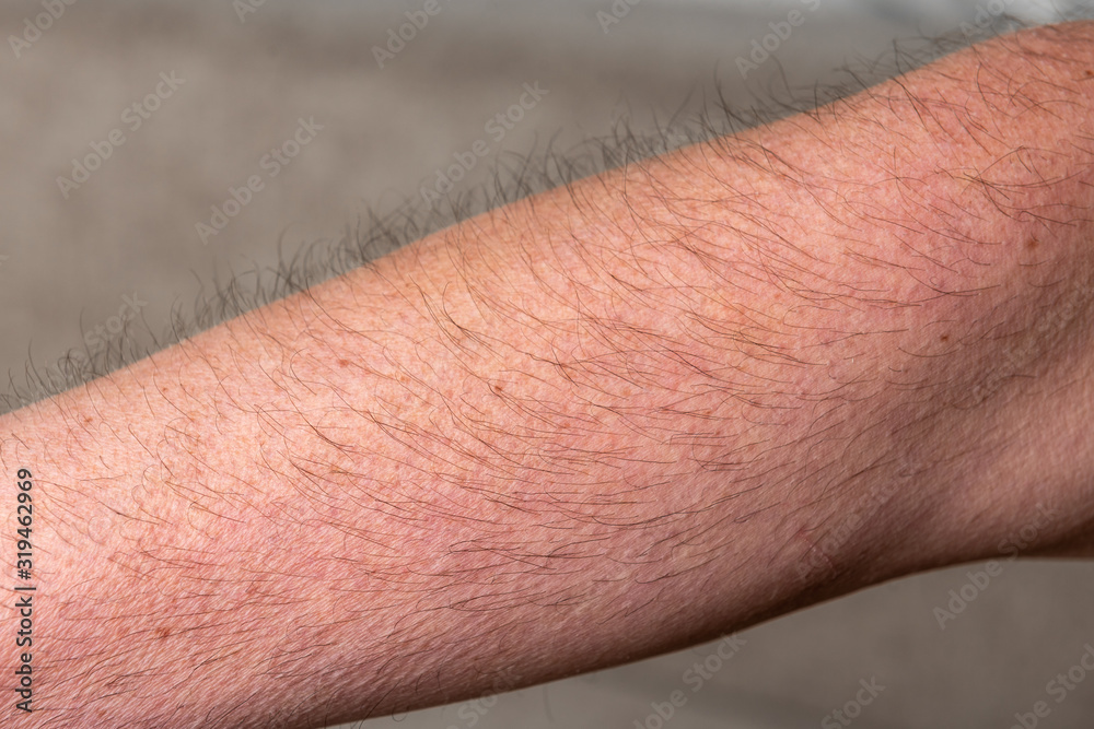 Arm hair of human are goosebump when the weather is cool or winter ...
