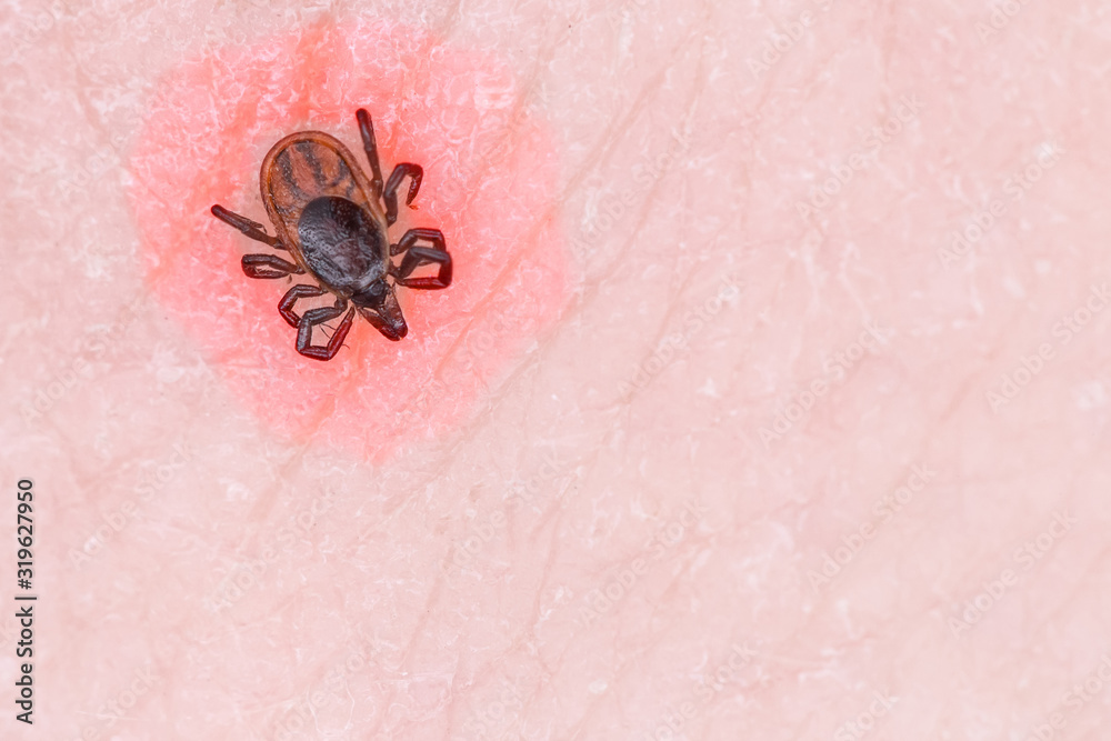 Tick sits on the skin of man. Tick bites a man. Danger of tick bites ...