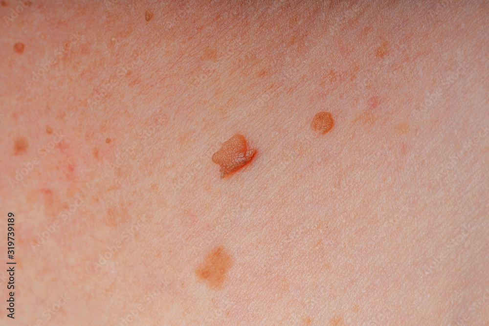 Age spots, moles and freckles on the body close-up. Spots on the body ...