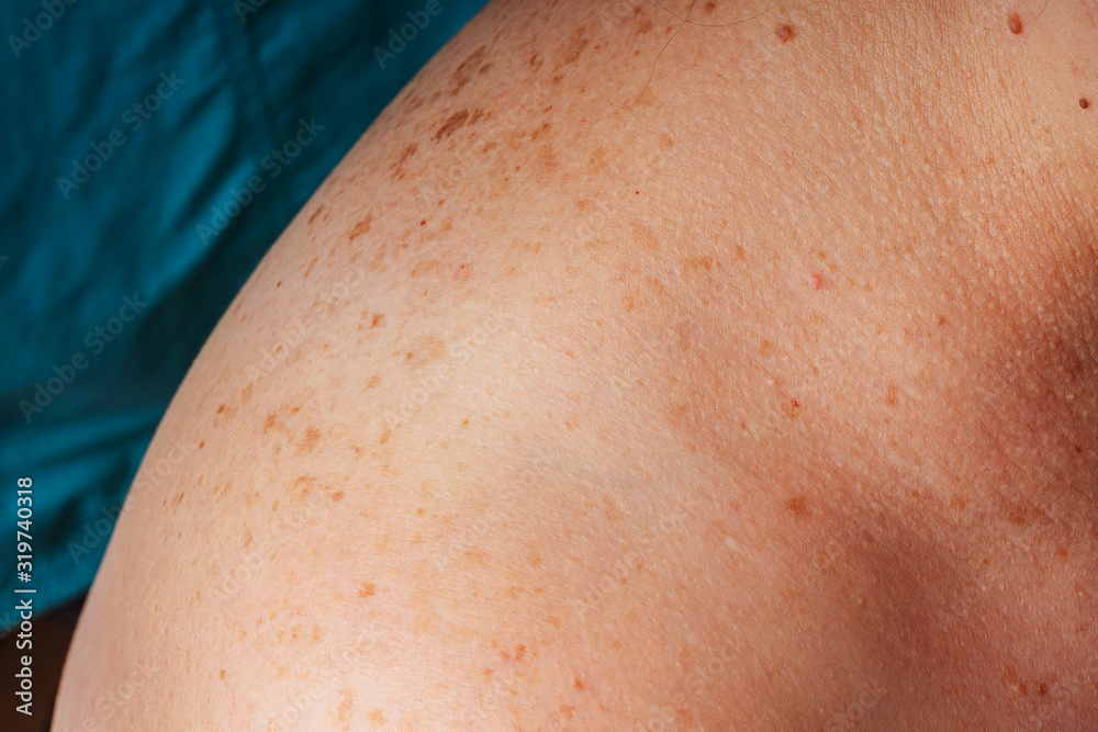 Age spots, moles and freckles on the shoulders and back of an older ...