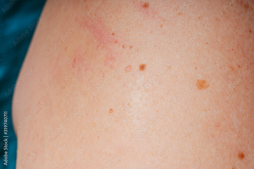 Age spots, moles and freckles on the shoulders and back of an older ...