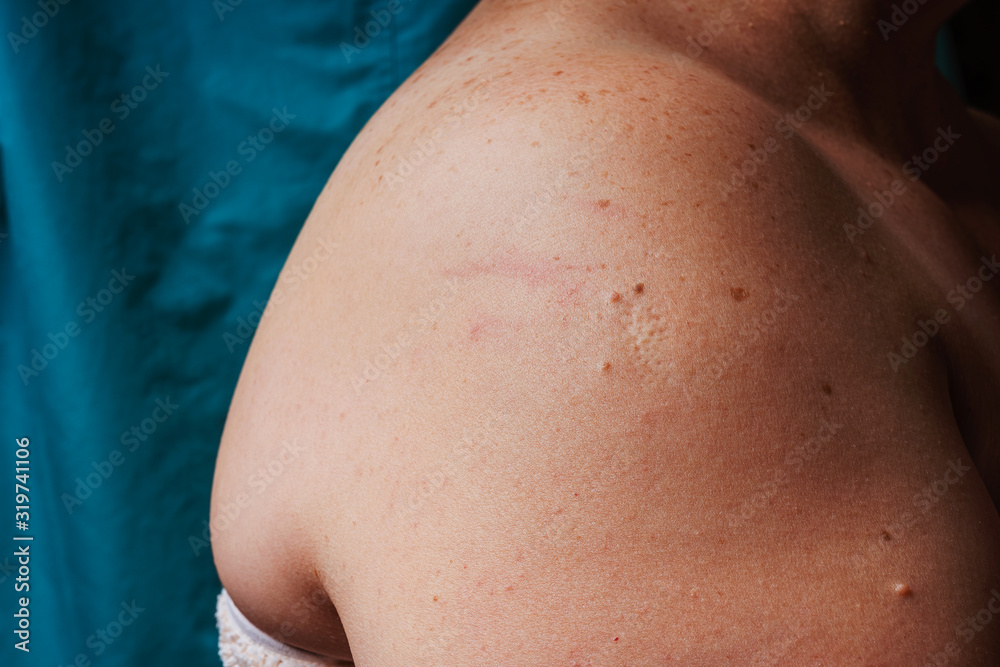 Age spots, moles and freckles on the shoulders and back of an older ...