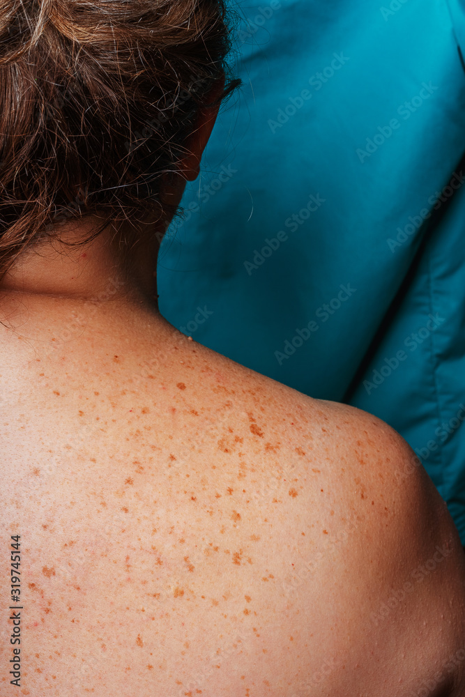 Age spots, moles, and freckles on the back of an older woman ...