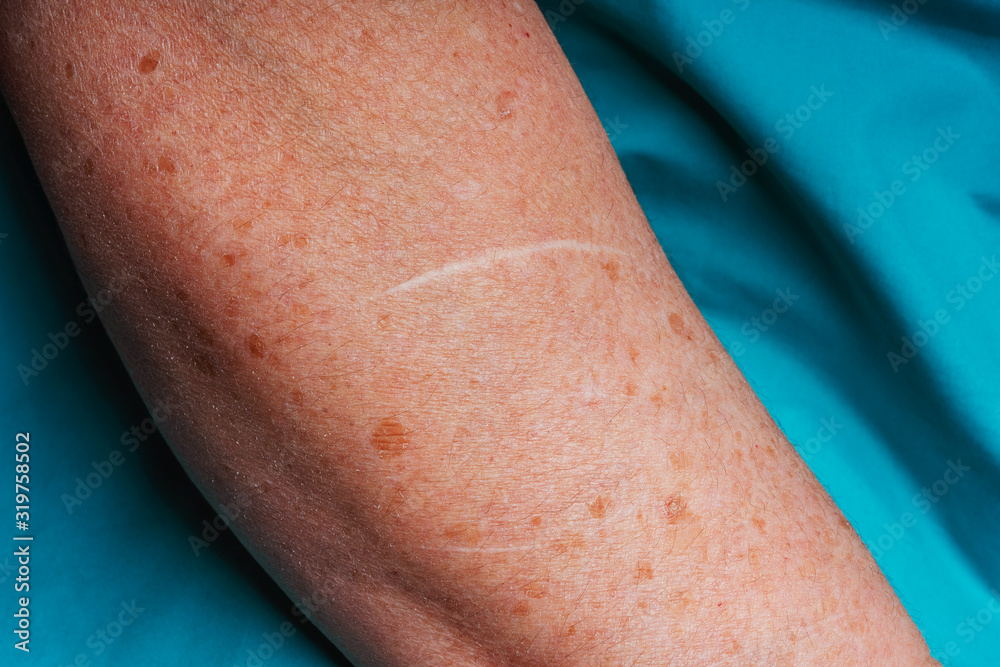Old scars on an elderly woman's body. Scars and marks from a car crash ...