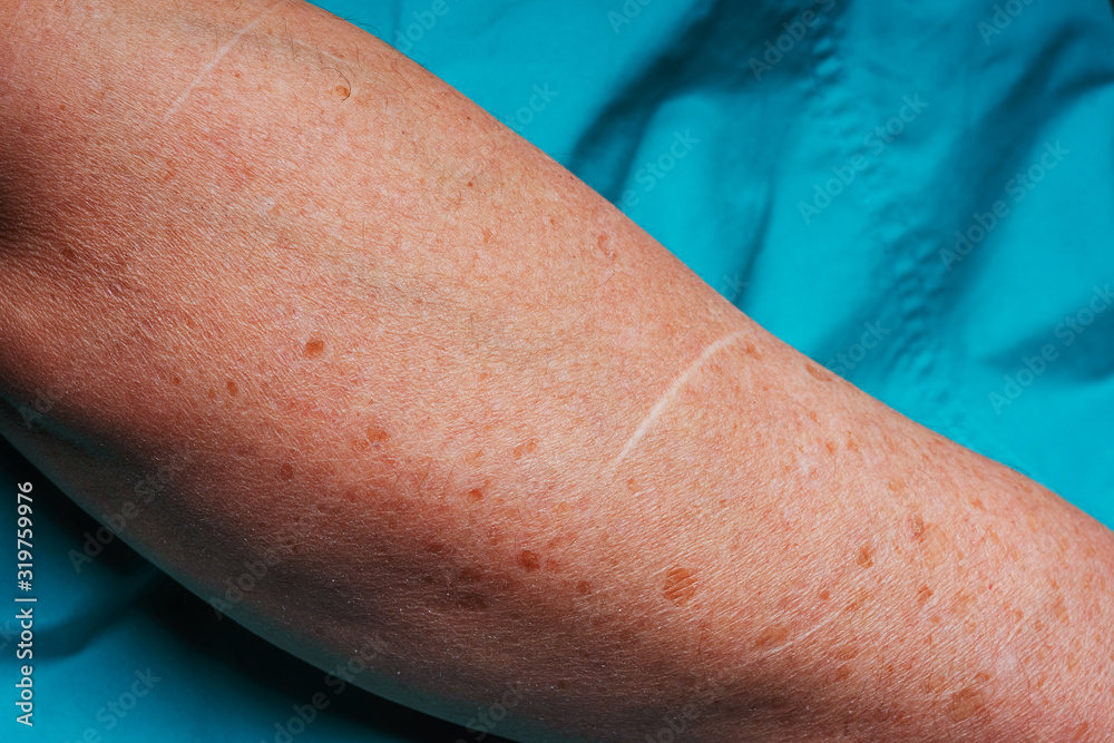 Old scars on an elderly woman's body. Scars and marks from a car crash ...