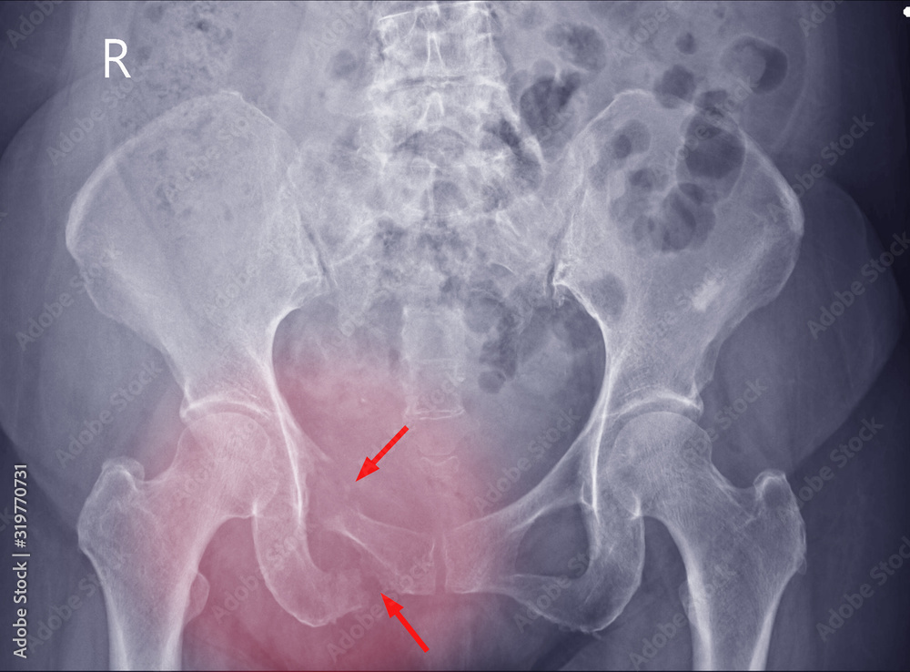 Pelvis and hips joint x-ray Stock Photo | Adobe Stock