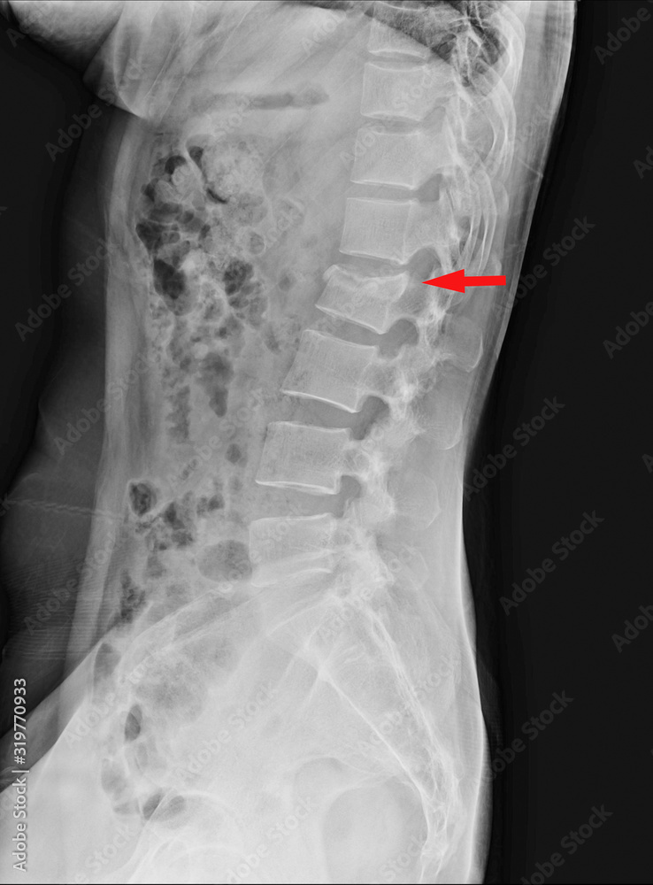 Lumbar spine compression fracture of L2. Stock Photo | Adobe Stock