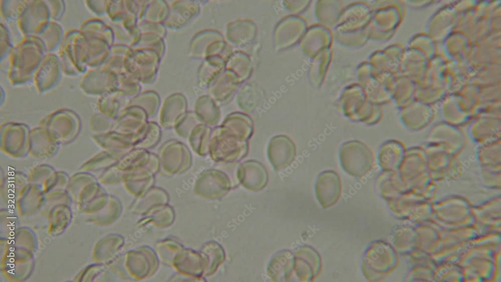 Vidéo Stock Human Blood, Diseases, Interstitial Fluid, Bacterial ...